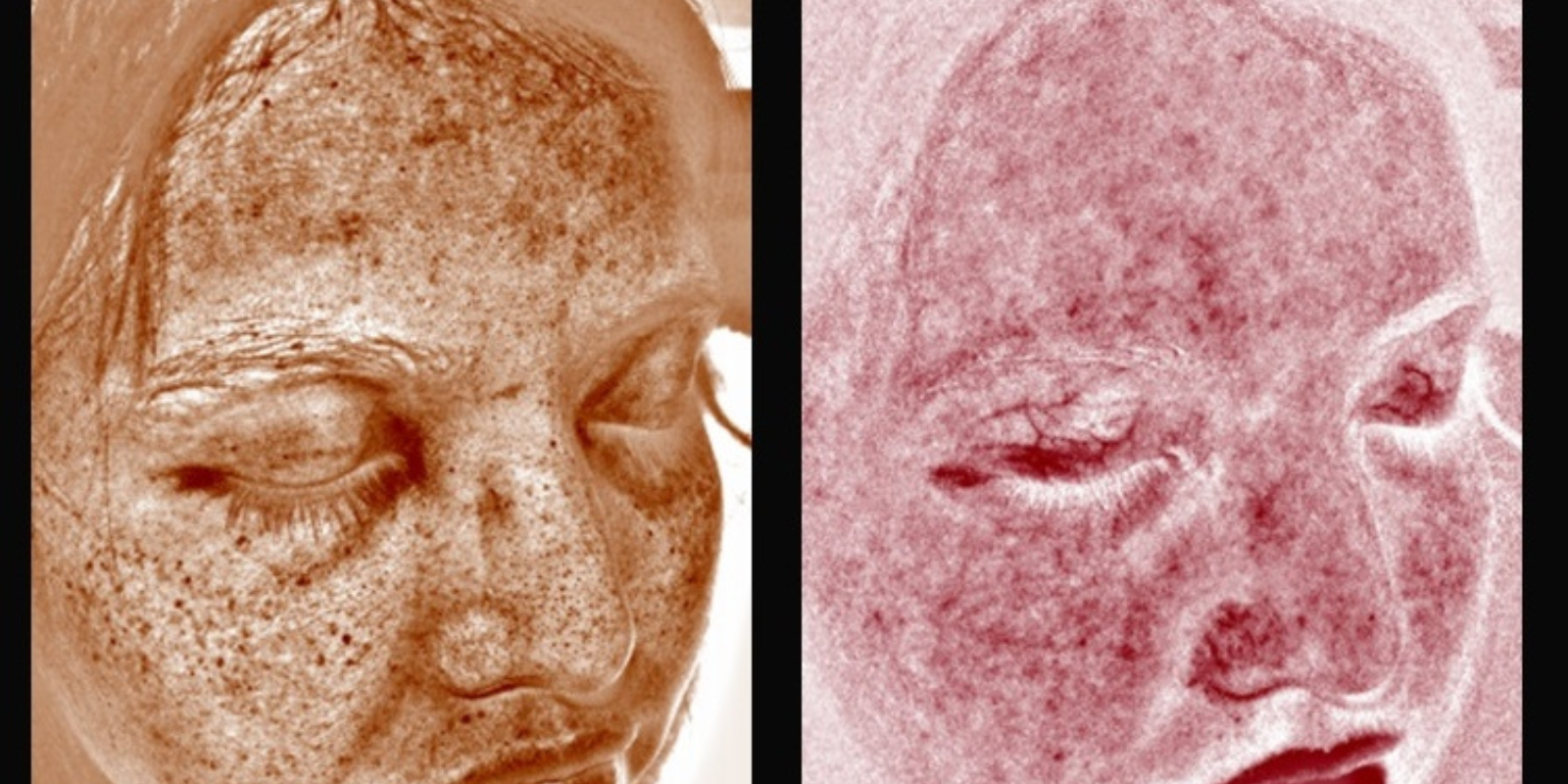 UV Camera Shows Importance of Sun Safety